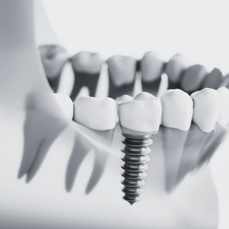 Revitalize Your Smile | Dental Implants in Springfield OH