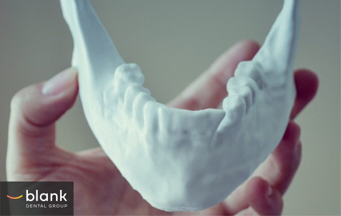 The Connection Between Dental Implants and Jawbone Health